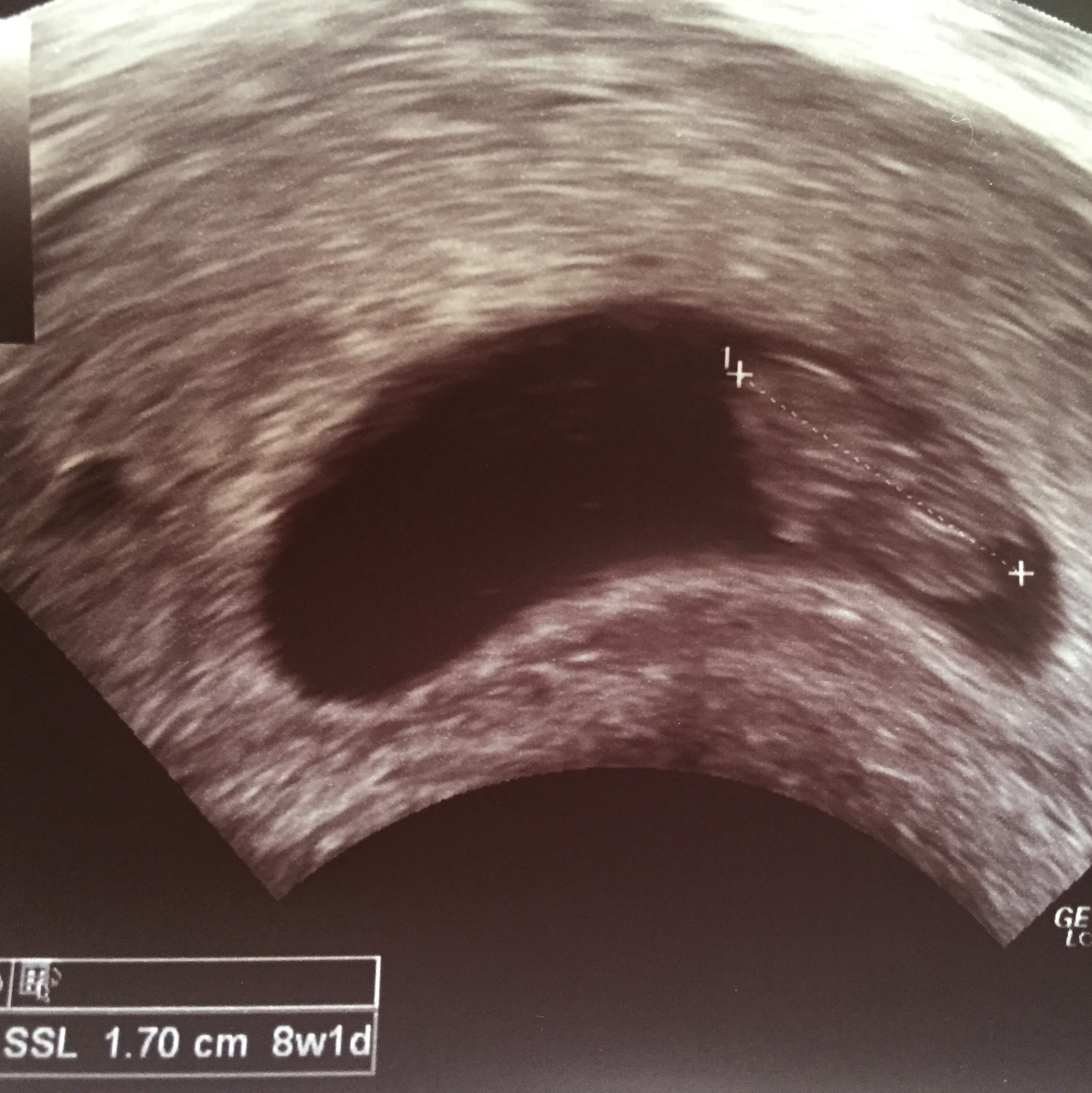 Schwangerschaftstagebuch: 8. und 9. SSW - LÄCHELN UND WINKEN